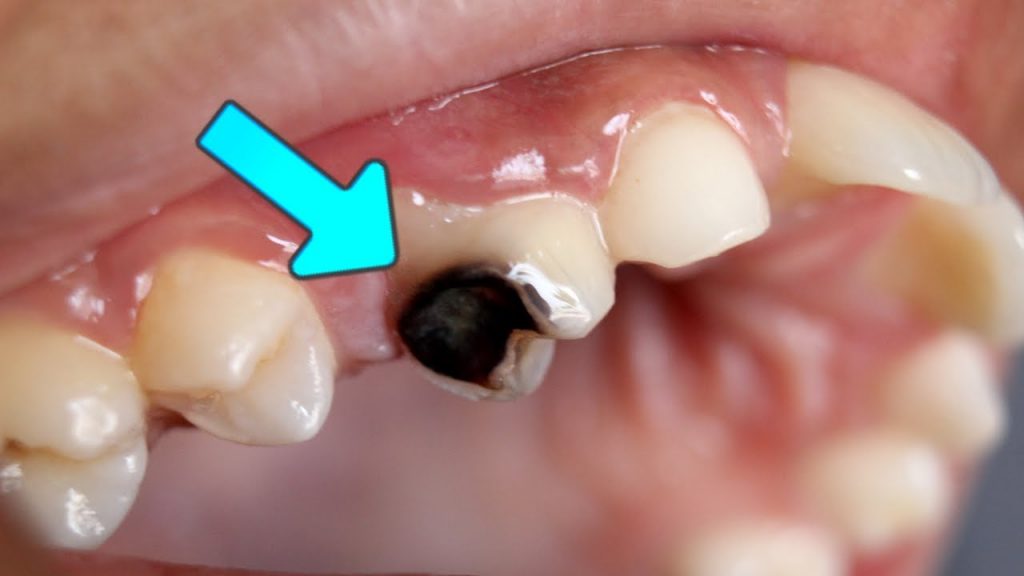 What Causes Cavities Tooth Decay And Dental Caries Why Do We Get What Causes Cavities Tooth Decay And Dental Caries Why Do We Get